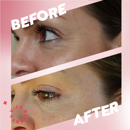 Vice Reversa Micro Needling Plumping Patches 8 pack AU | Adore Beauty